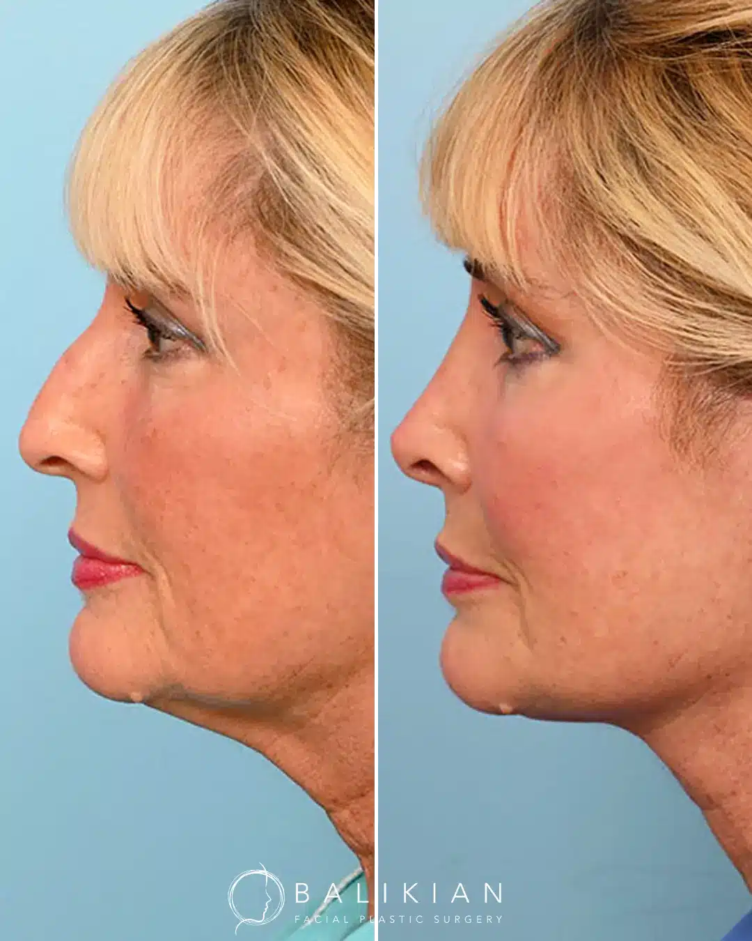 CO2 Laser Resurfacing Before & After Gallery : Real Results