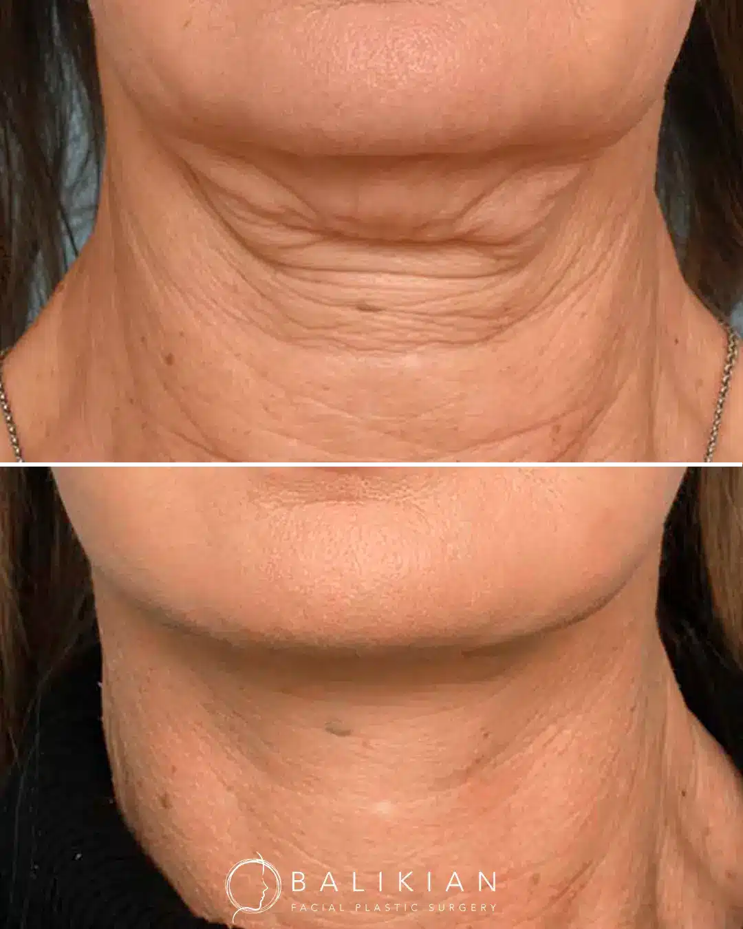 CO2 Laser Resurfacing Before & After Gallery : Real Results