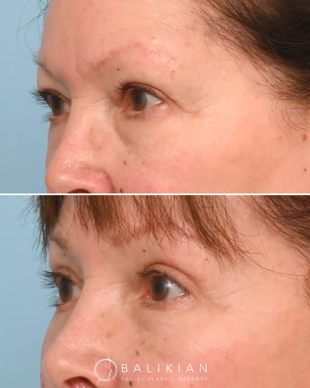 Blepharoplasty Before & After Gallery : Eyelid Transformations