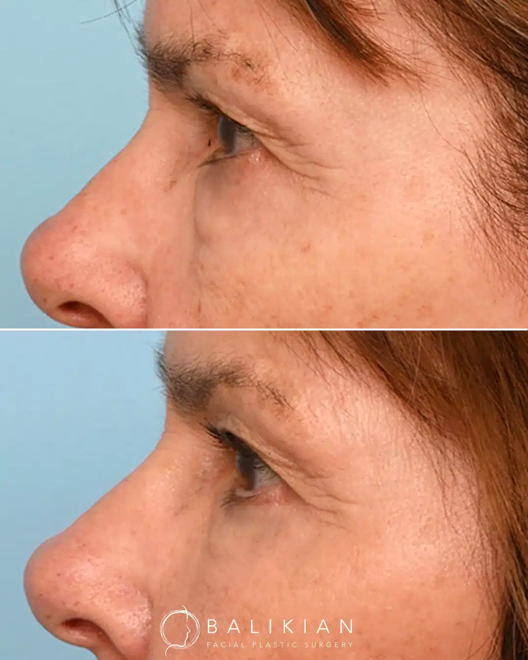 Blepharoplasty Before & After Gallery : Eyelid Transformations