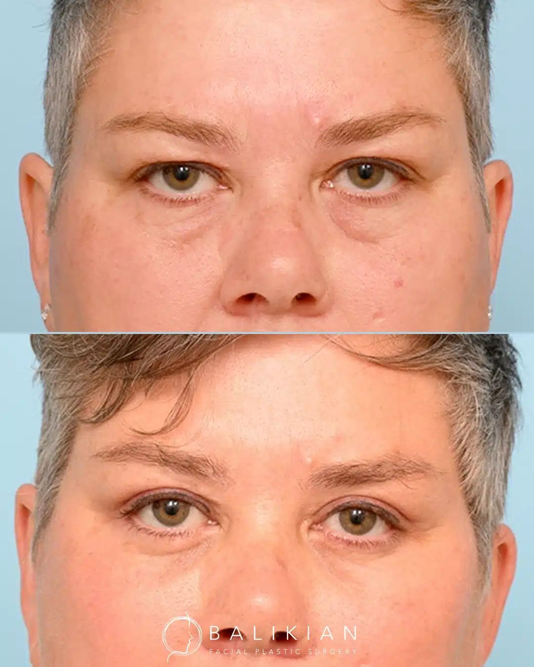 Scarless Lower Eyelid Surgery With Optional Skin Pinch