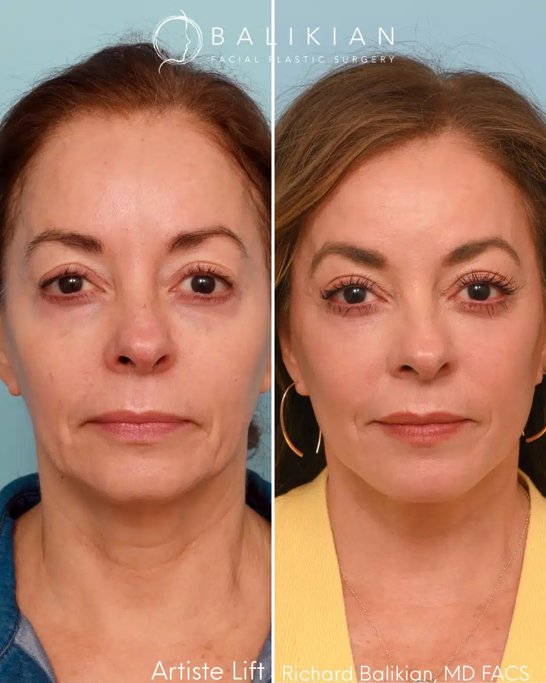What Surgeons See Beneath the Surface During Facelift Surgery