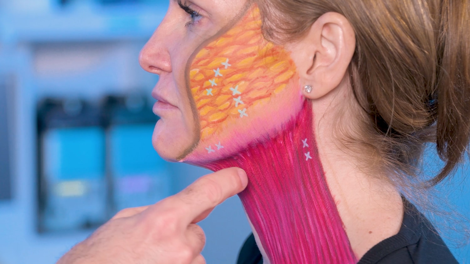 Platysma Muscle Anatomy | Why Neck Bands Develop